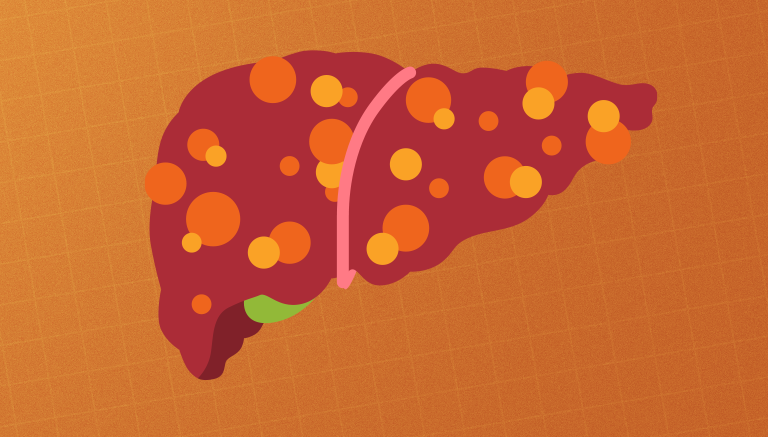 Esteatose Hepática - Tudo Sobre Fígado